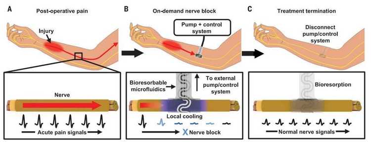 Is This Thin, Stretchy Device the Answer to the Opioid Crisis ...